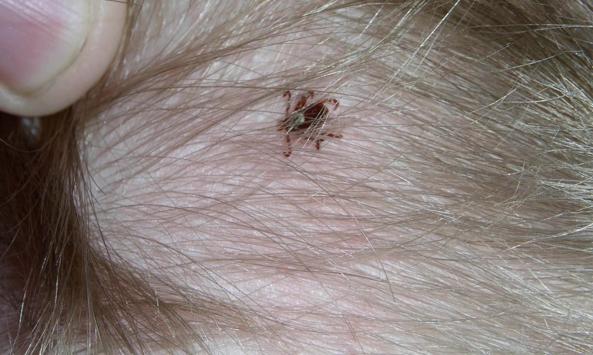 Ticks and Tick Bites - Covenant Care Pediatrics